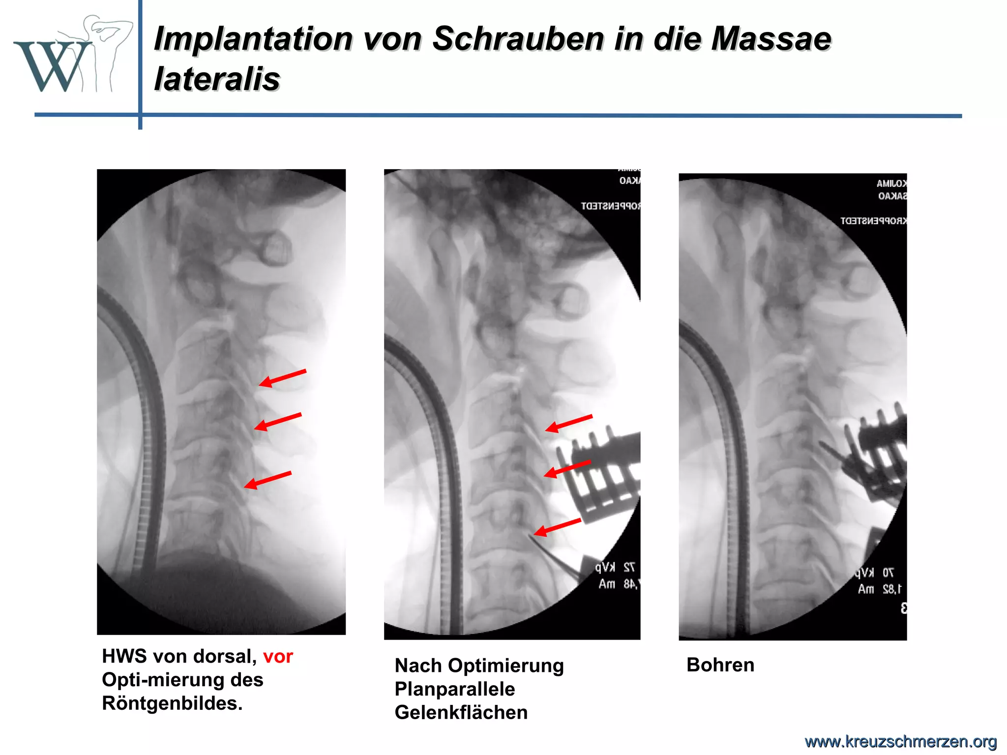 The cervical myelopathy. | PPT