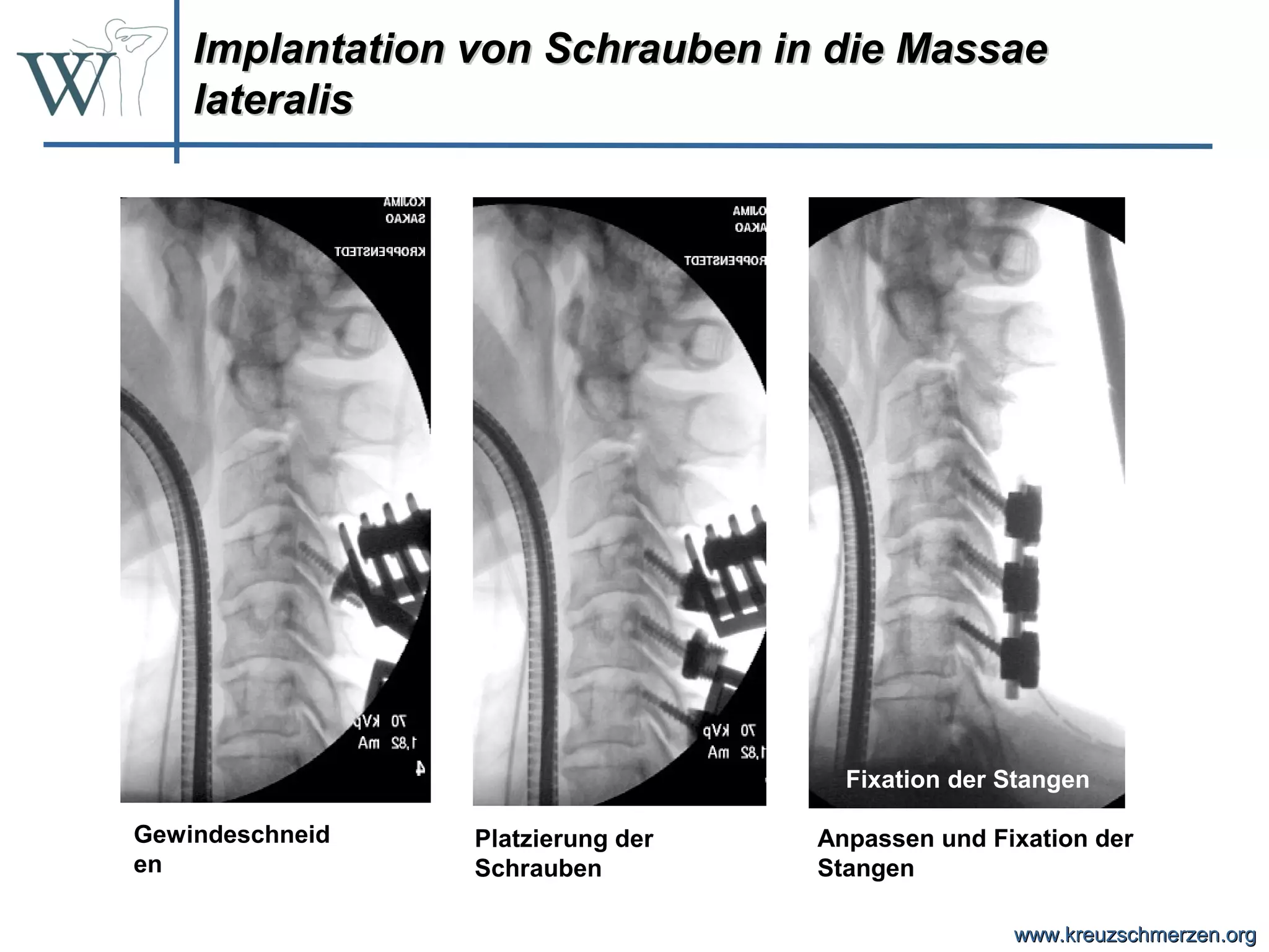 The cervical myelopathy. | PPT