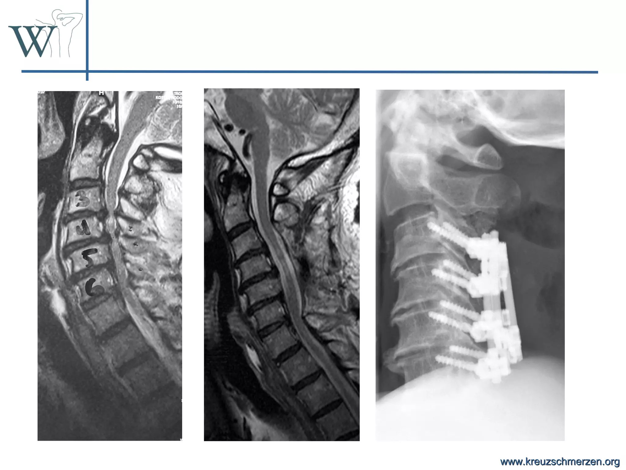 The cervical myelopathy. | PPT