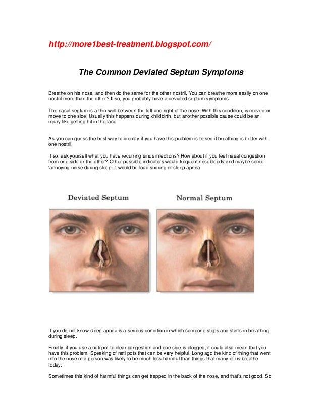 Deviated Septum Causes Symptoms And Treatment