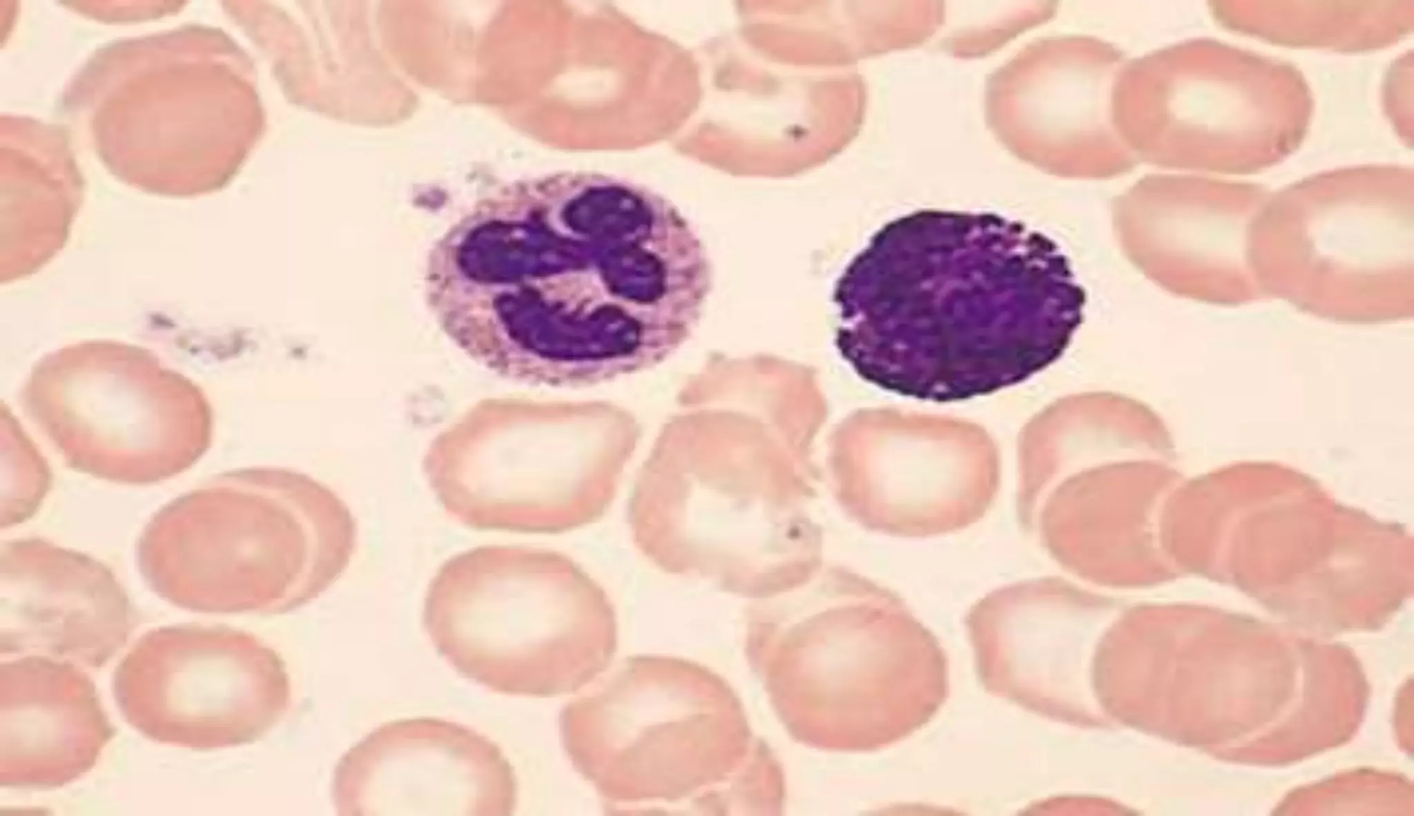 The complete blood count (cbc) | PPTX | Blood Disorders | Diseases and ...