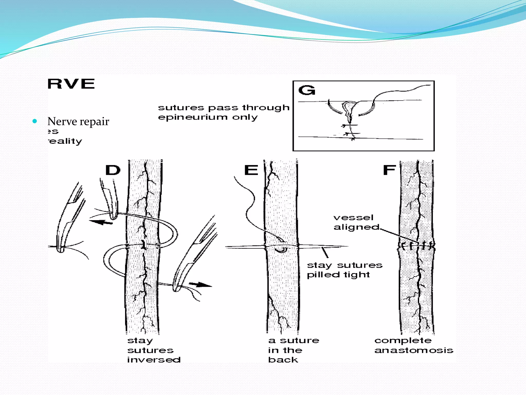 The concept of peripheral nerve repair | PPTX