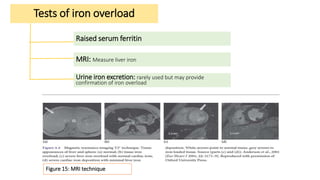 The control of body iron stores and laboratory investigation of anaemia ...