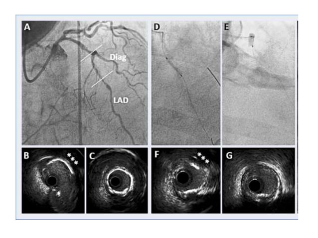 Coronary intravascular lithotripsy and lasers/ IVL | PPTX | First Aid ...
