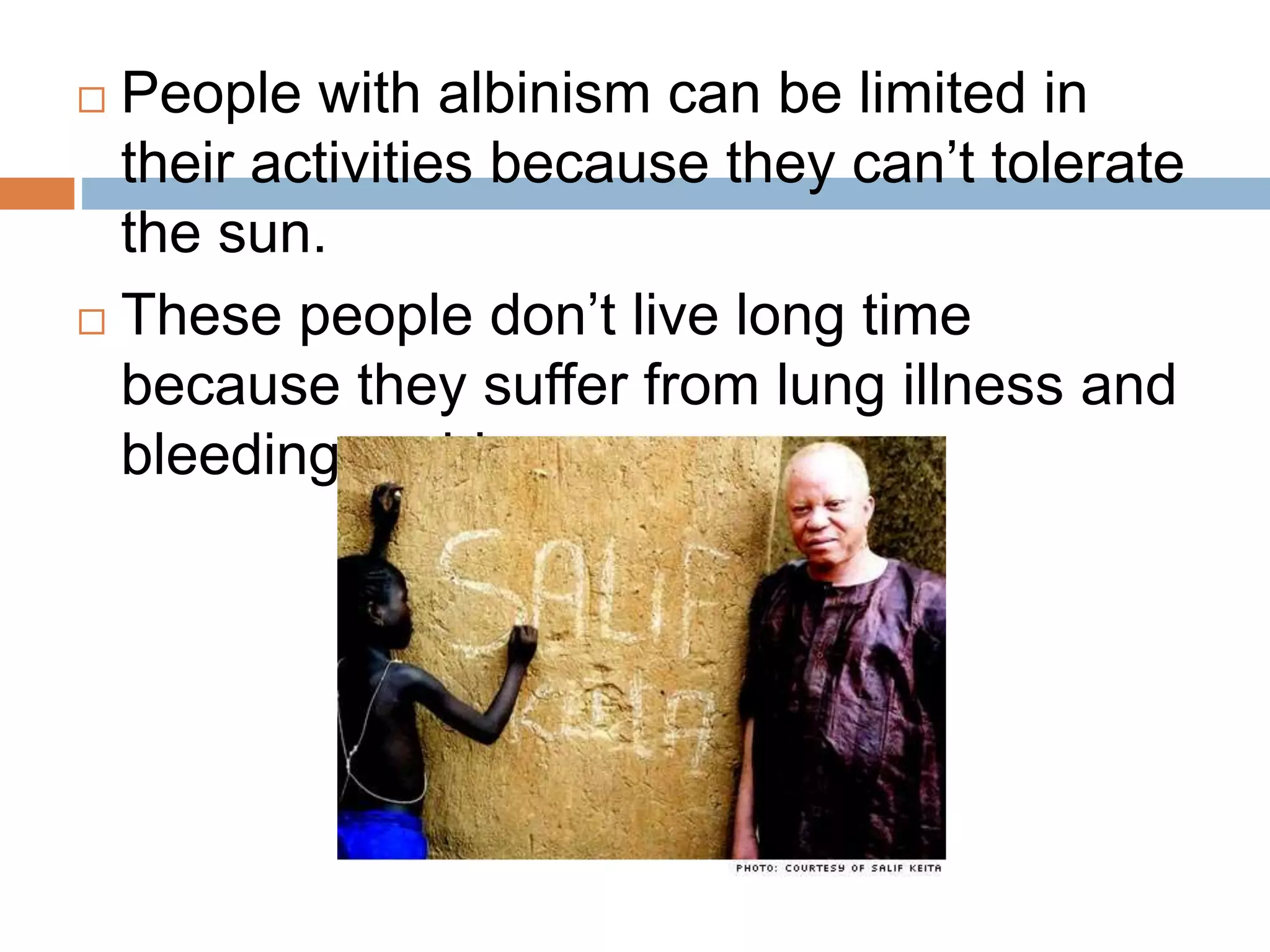 The danger of being albino in africa | PPT