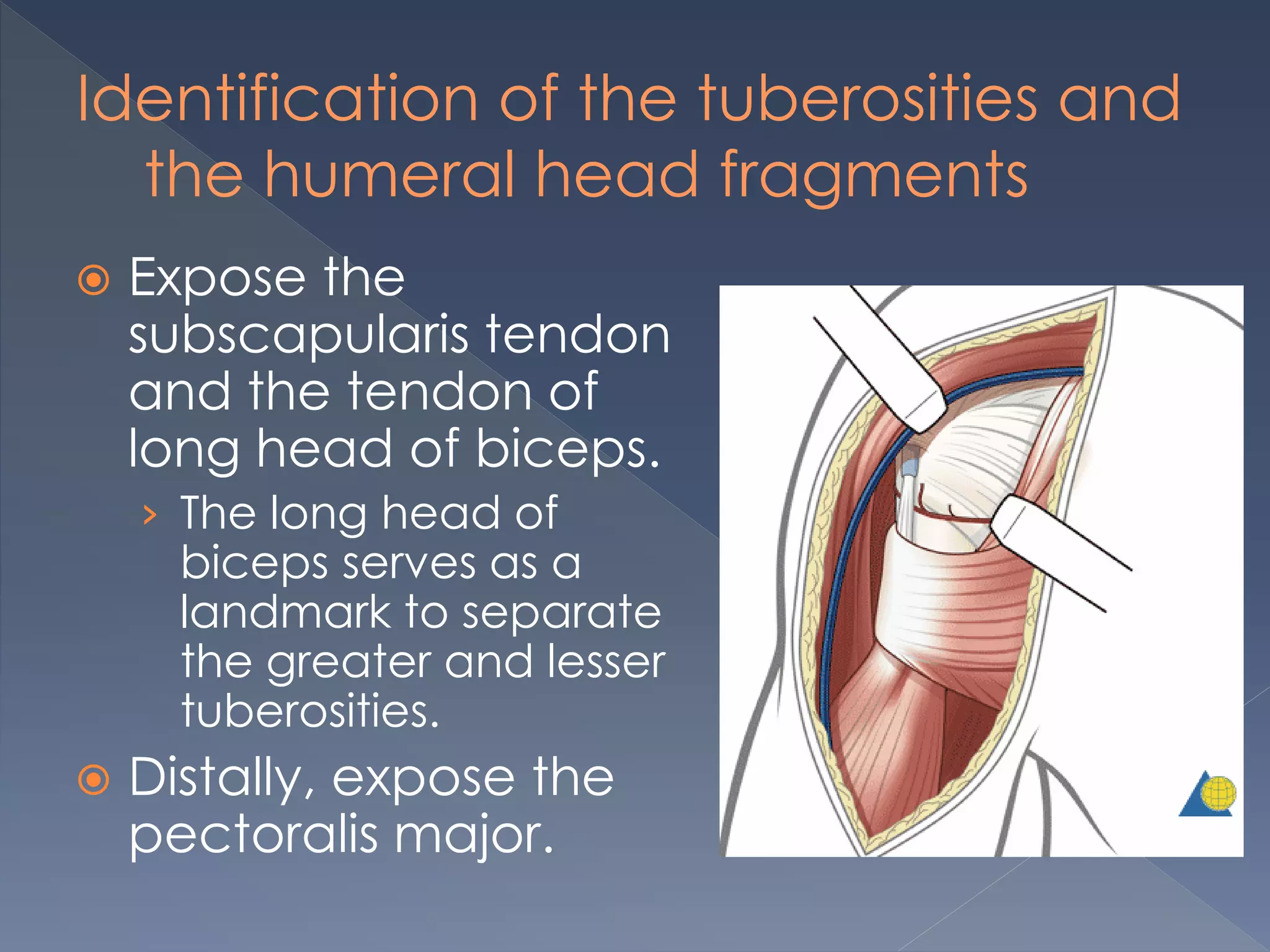 The deltopectoral approach | PDF