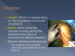 The deltopectoral approach | PPT