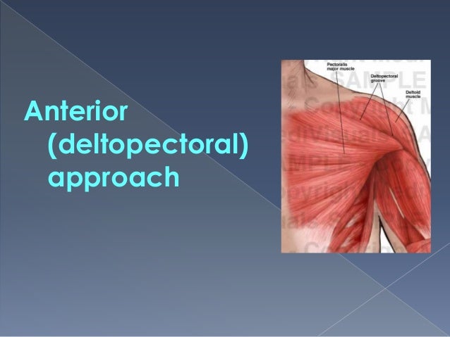 The deltopectoral approach