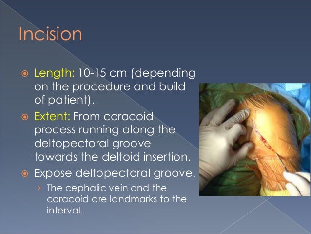 The deltopectoral approach