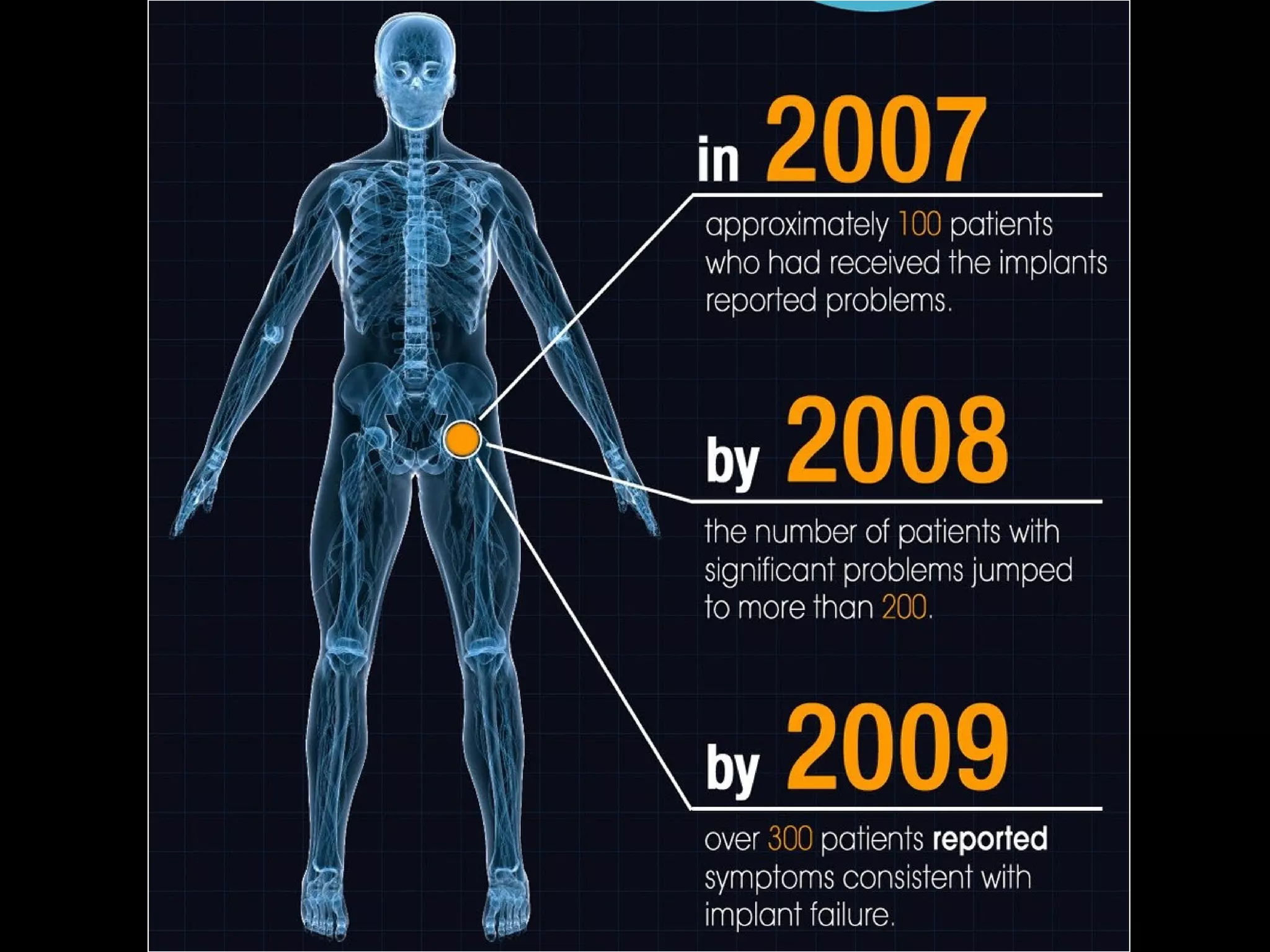 The Depuy ASR™ defective hip implant recall in pictures | PPT