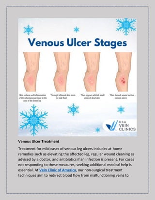 The Development Of A Venous Leg Ulcer Stages And Treatment | PDF | Skin ...