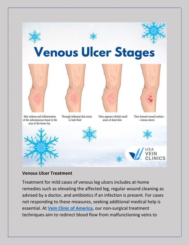 The Development Of A Venous Leg Ulcer Stages And Treatment | PDF