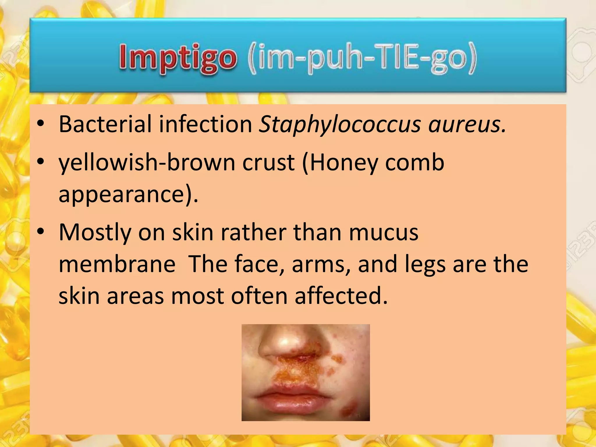 The differences between imptigo and herpes | PPTX