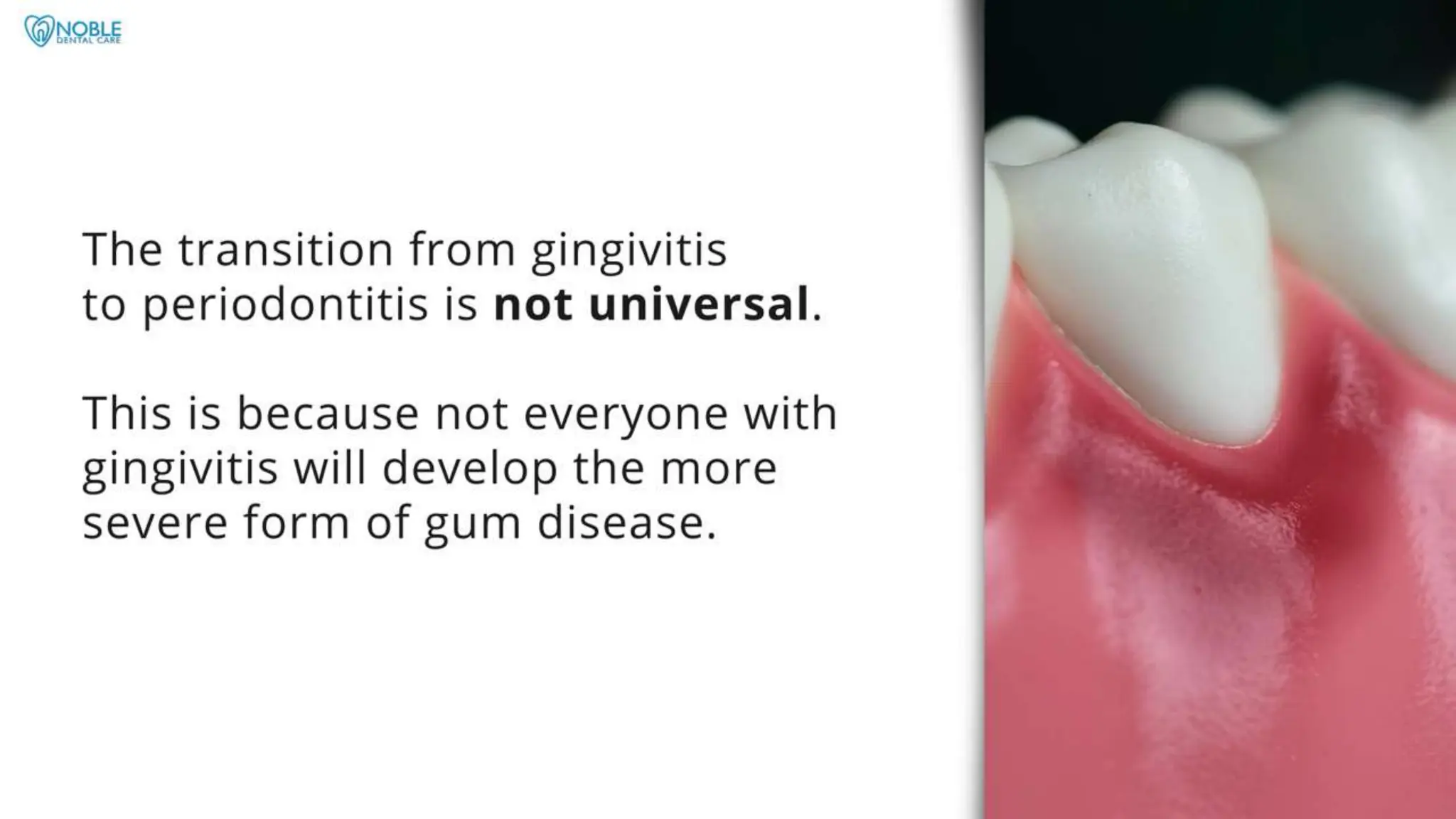 The Difference Between Periodontitis and Gingivitis | PPTX | Dental ...