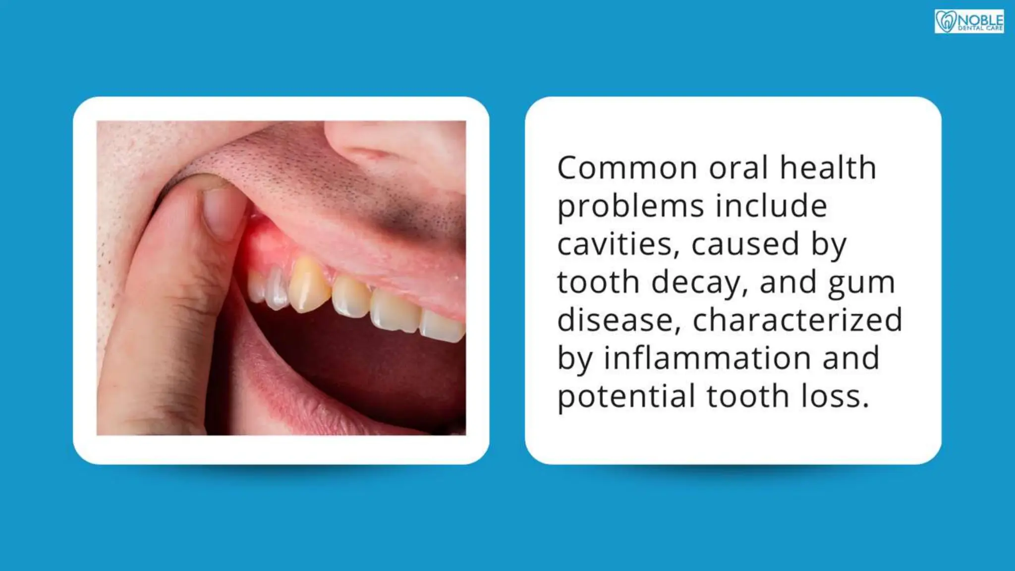 The Difference Between Periodontitis and Gingivitis | PPTX | Dental ...