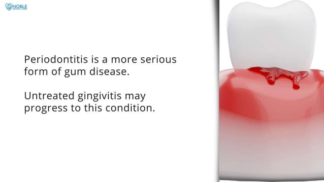 The Difference Between Periodontitis and Gingivitis | PPTX | Dental ...