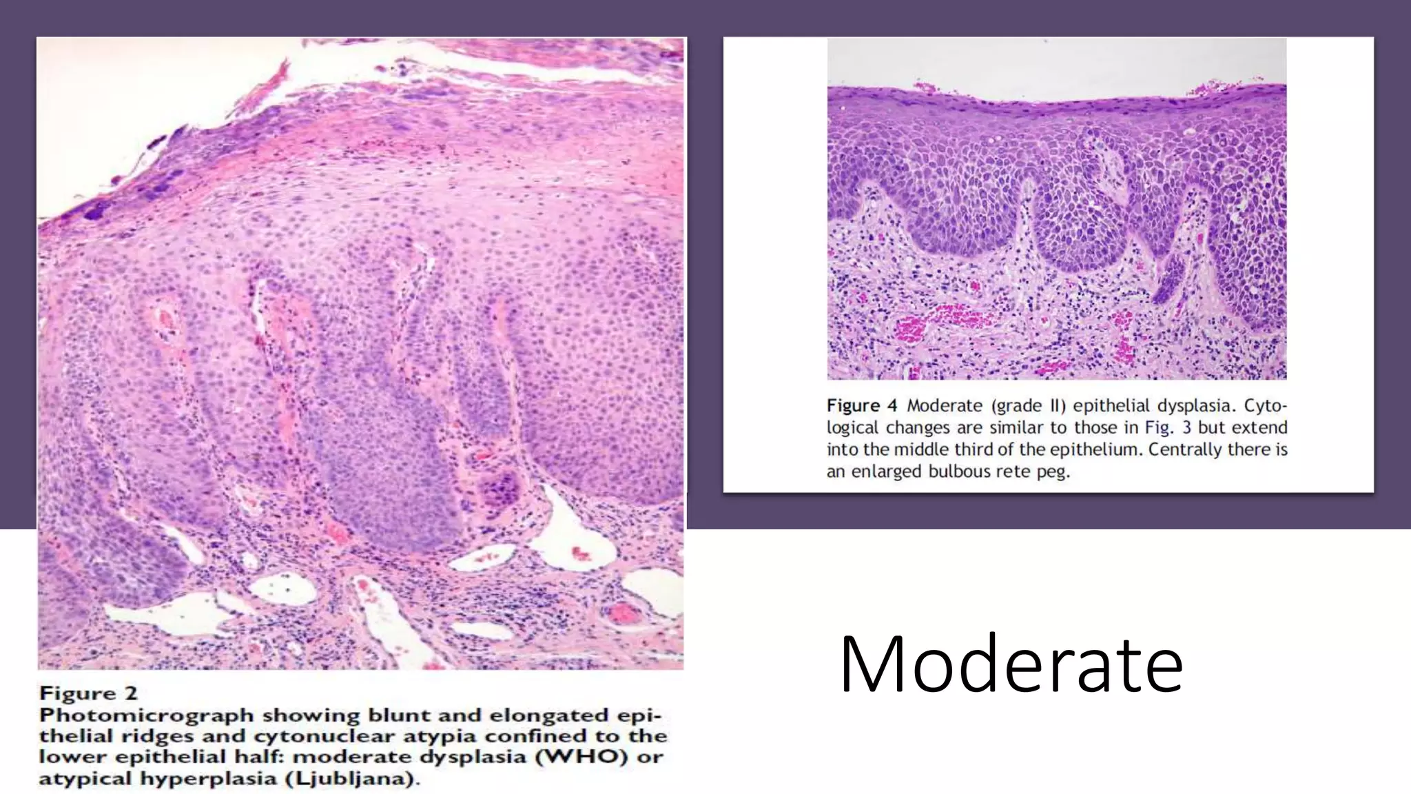 The different grading schemes for oral epithelial dysplasia (Doctor ...