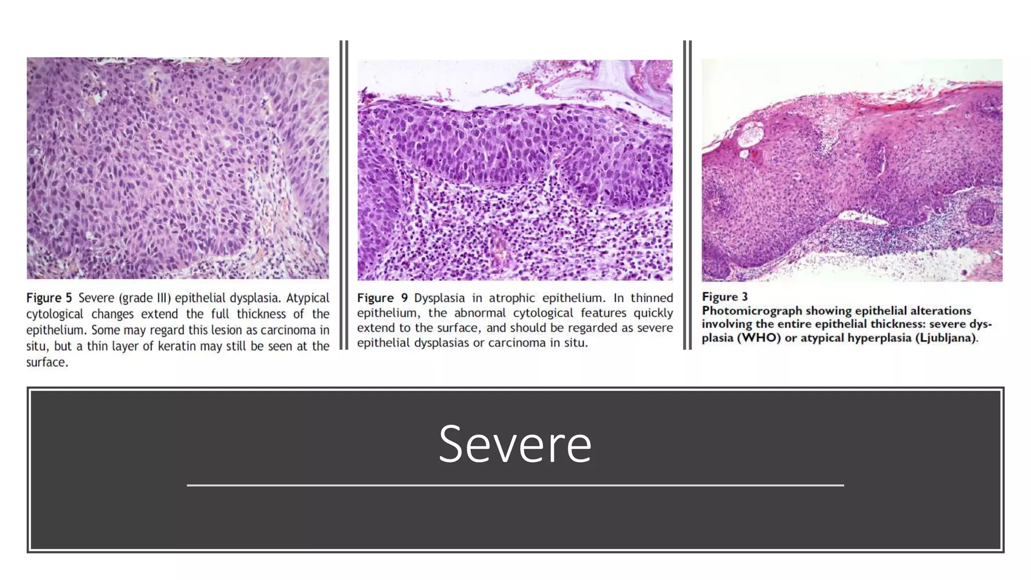 The different grading schemes for oral epithelial dysplasia (Doctor ...