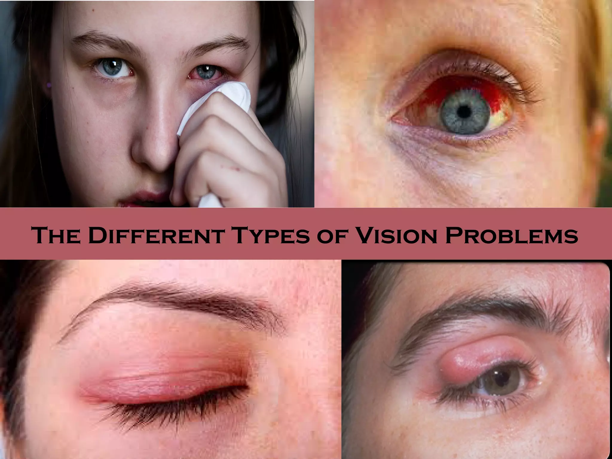 The different types of vision problems | PDF
