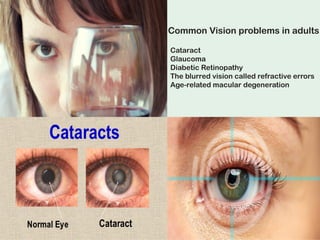 The different types of vision problems | PDF
