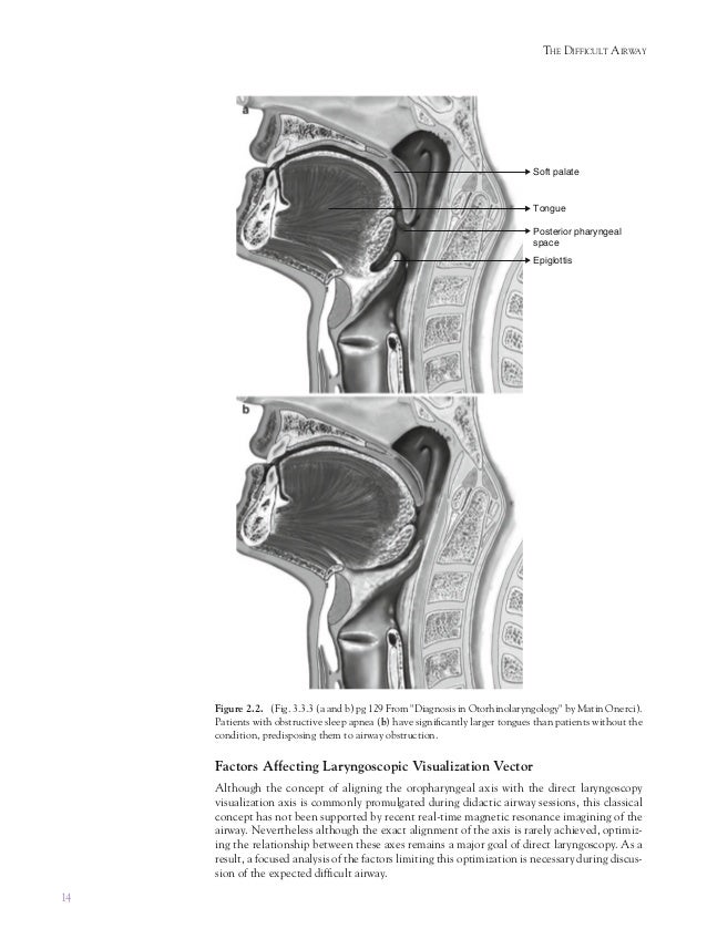 The Difficult Airway