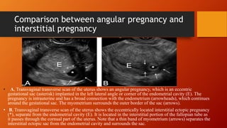 The dilemma of eccentrically located gestational sac | PPTX