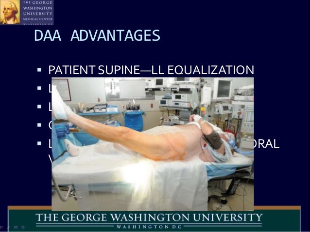 The Direct Anterior Hip Replacement The Direct Anterior Hip Replacement