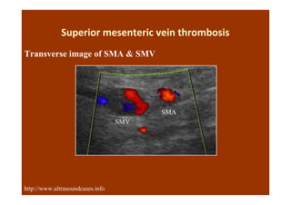 The diseased liver ..a look in pretransplant evaluation | PDF