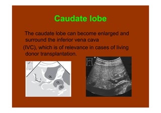 Enlarged Caudate Lobe Of Liver