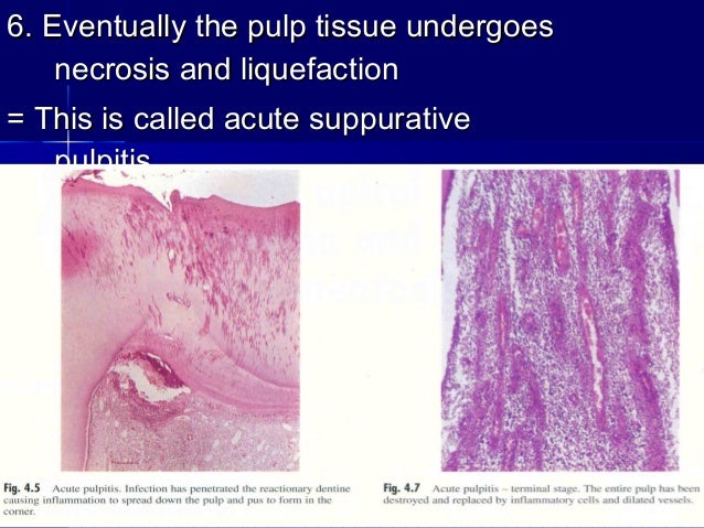 The disease of the dental pulp
