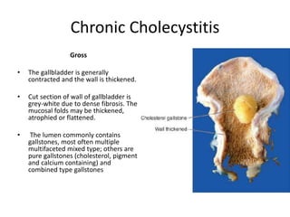 Chronic Cholecystitis Gross