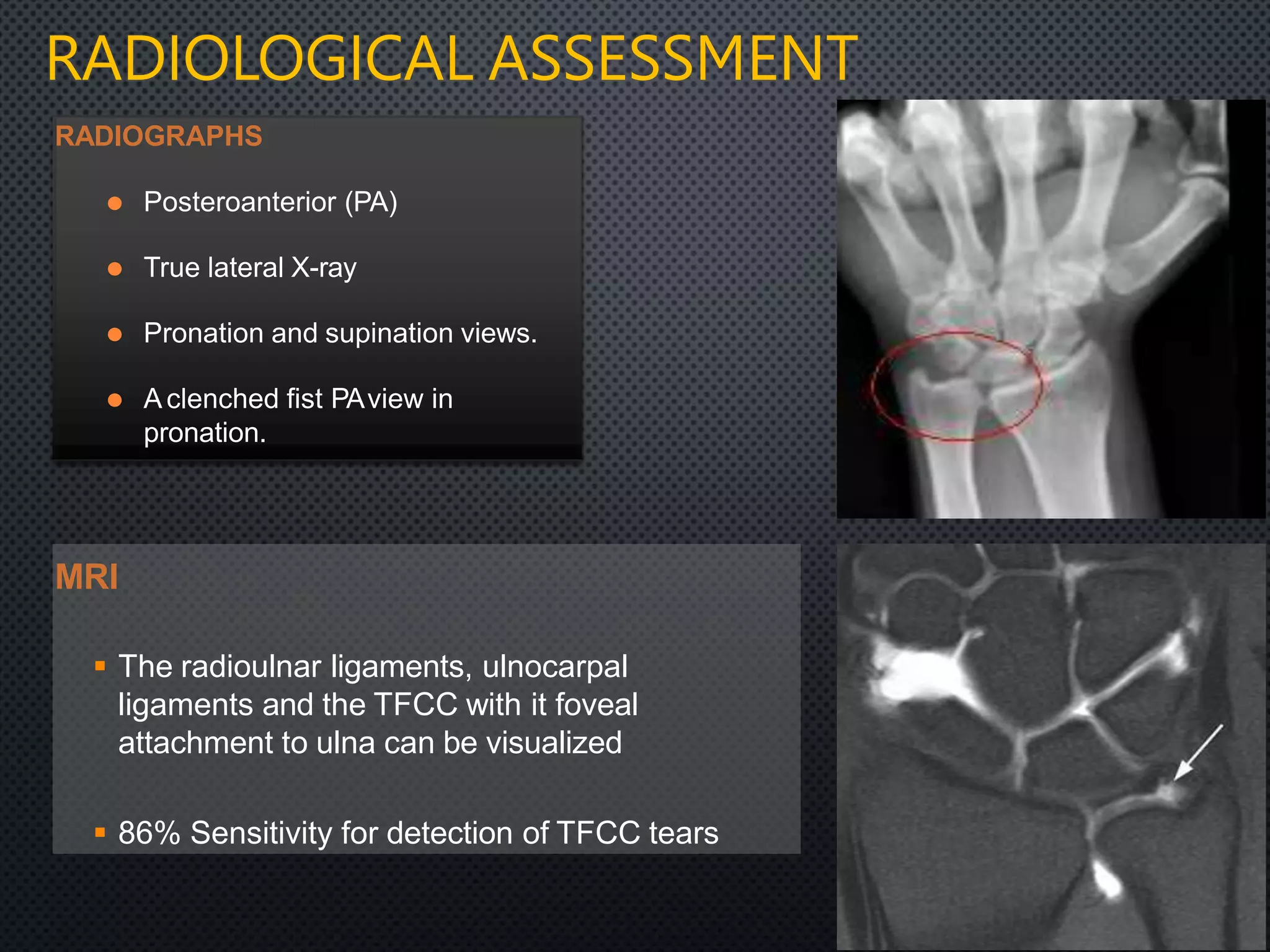 THE DISTAL RADIOULNAR JOINT AND TFCC.pptx