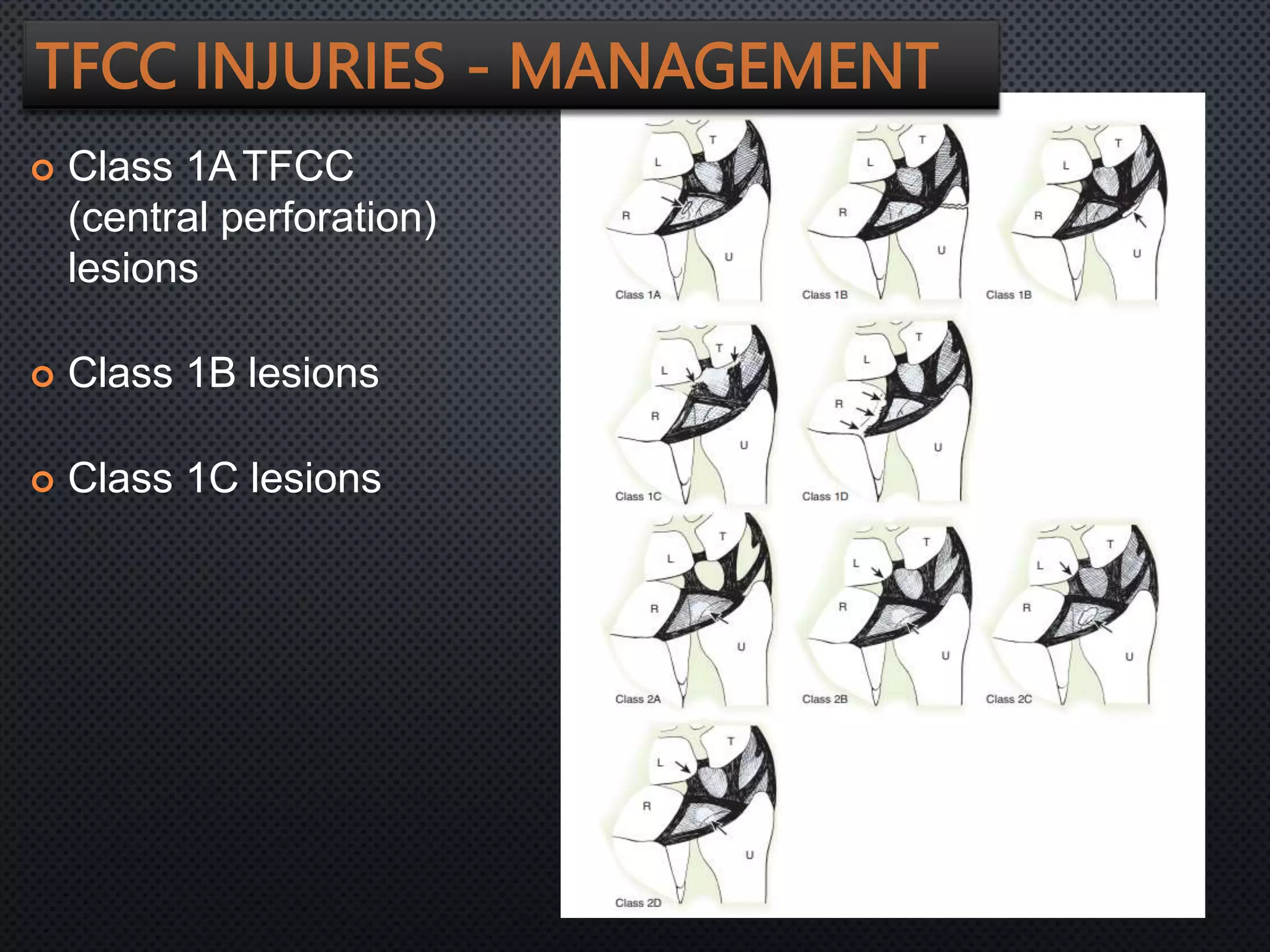 THE DISTAL RADIOULNAR JOINT AND TFCC.pptx