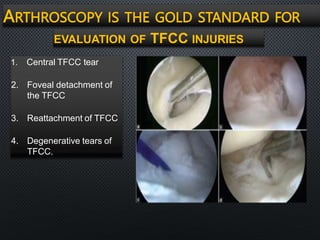 THE DISTAL RADIOULNAR JOINT AND TFCC.pptx