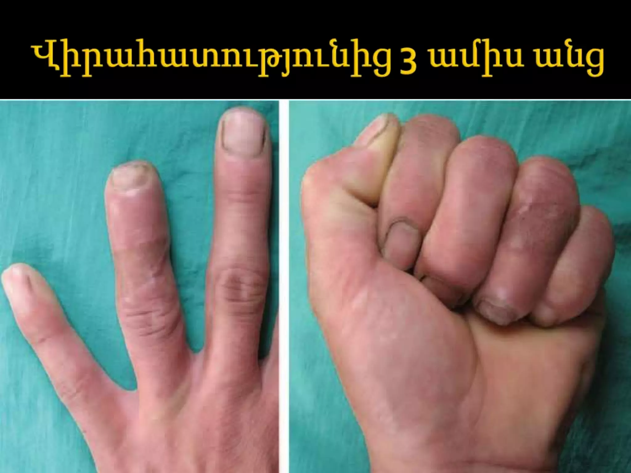 The dorsal homodigital island flap | PPT