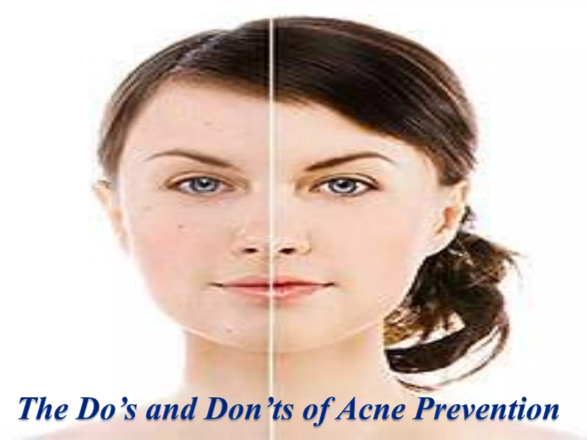 The Do’s and Don’ts of Acne Prevention | PPTX