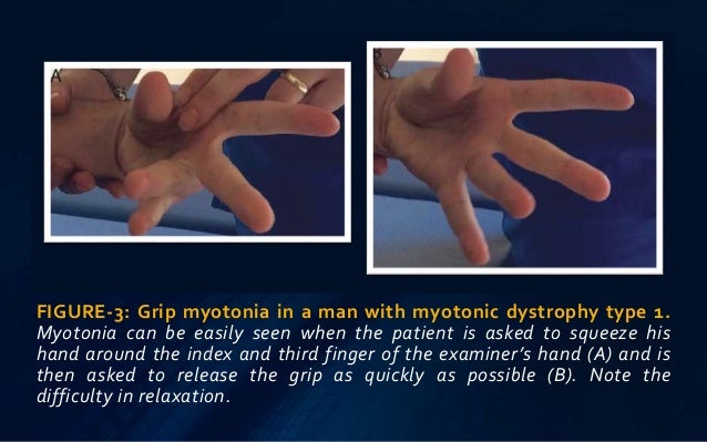 Myotonia- An approach to diagnosis