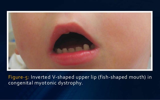 Myotonia- An approach to diagnosis