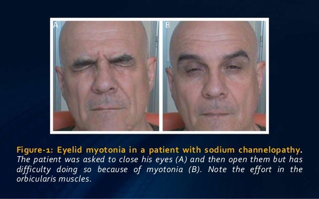 Myotonia- An approach to diagnosis