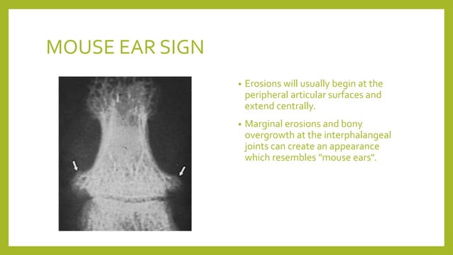 Ear signs in radiology | PPTX | Death, Injury, or Military Conflict ...