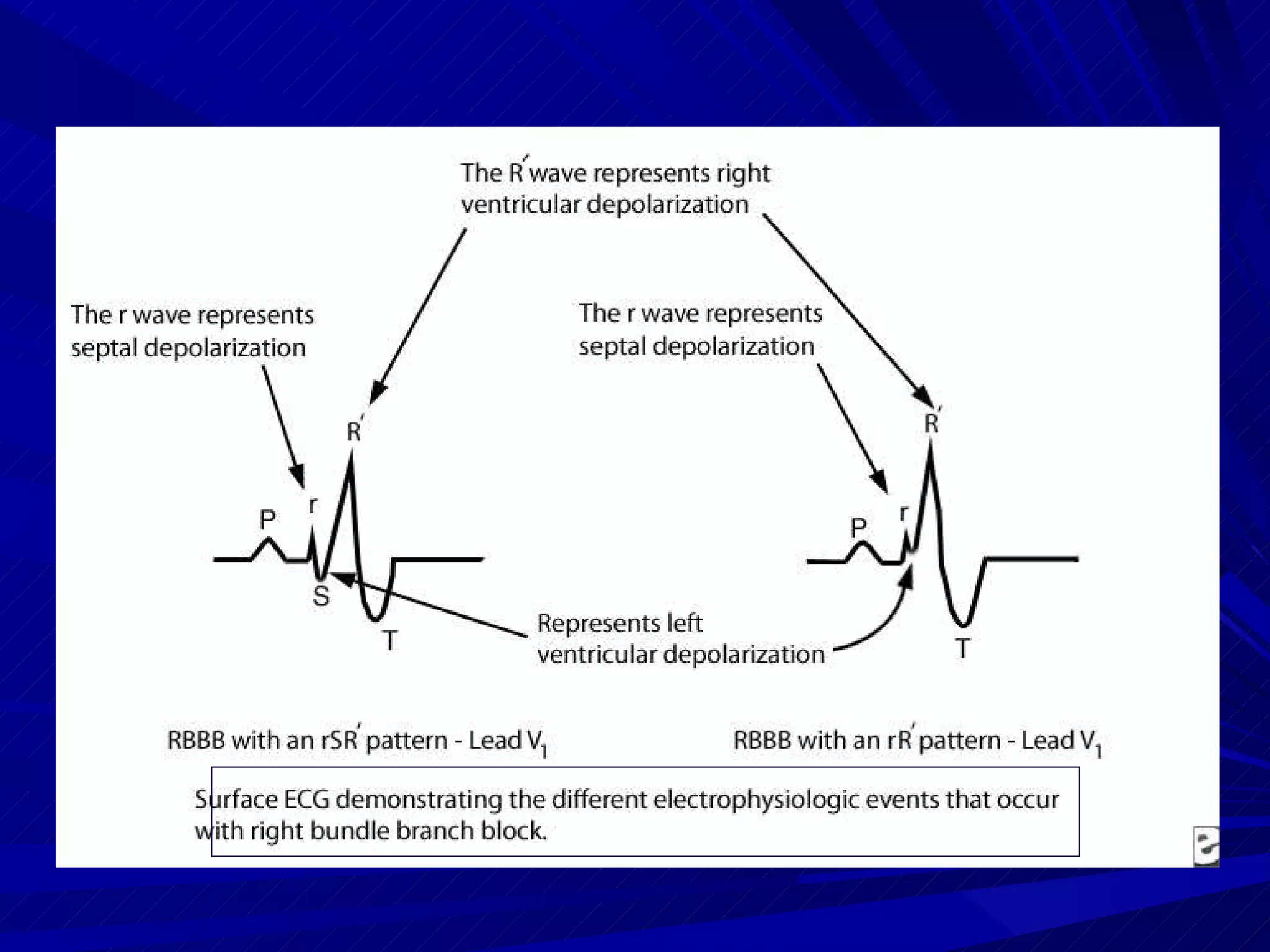 ECG: RBBB with LAFB | PPT