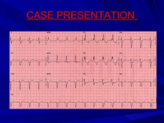 ECG: RBBB with LAFB | PPT