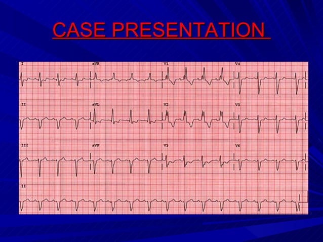 ECG: RBBB with LAFB | PPT