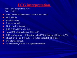 ECG: RBBB with LAFB | PPT