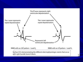 ECG: RBBB with LAFB | PPT