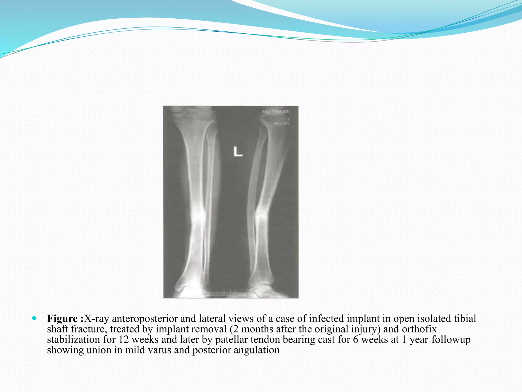 The effect of intact fibula on functional outcome of reamed ...