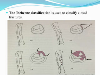 The effect of intact fibula on functional outcome of reamed ...