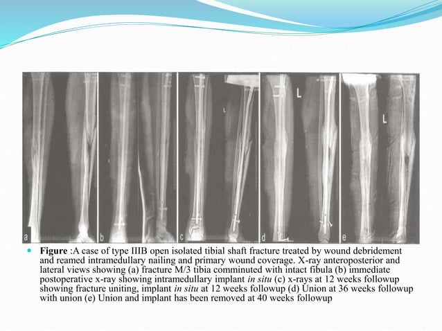 The effect of intact fibula on functional outcome of reamed ...