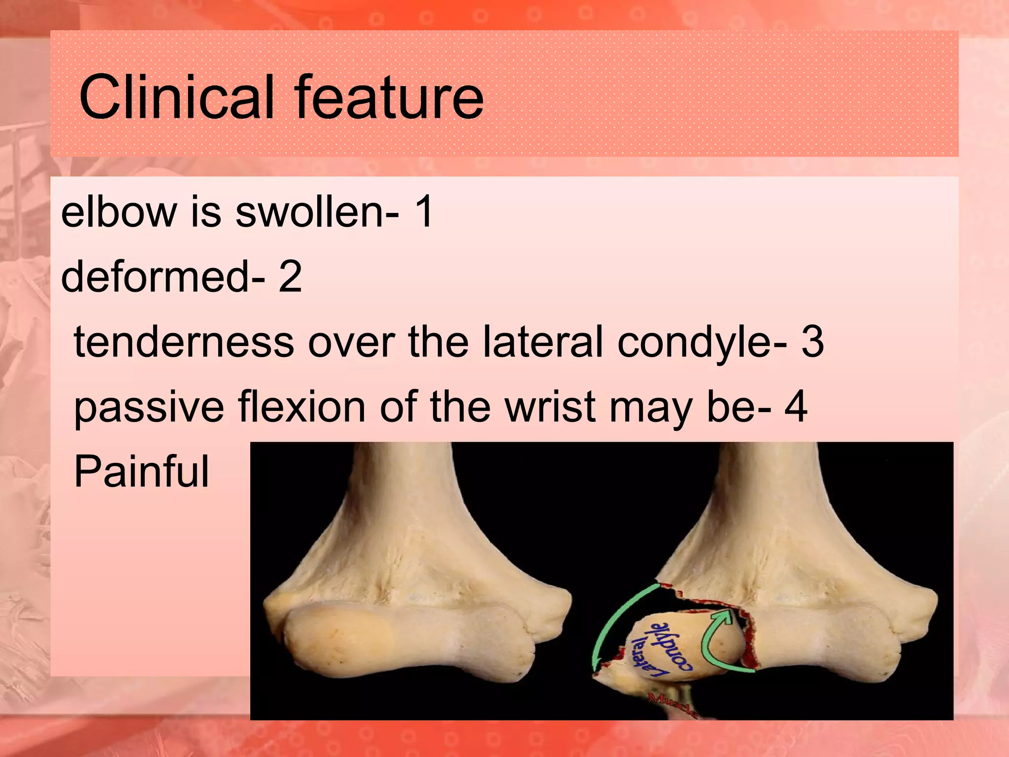 The elbow fracture | PPT