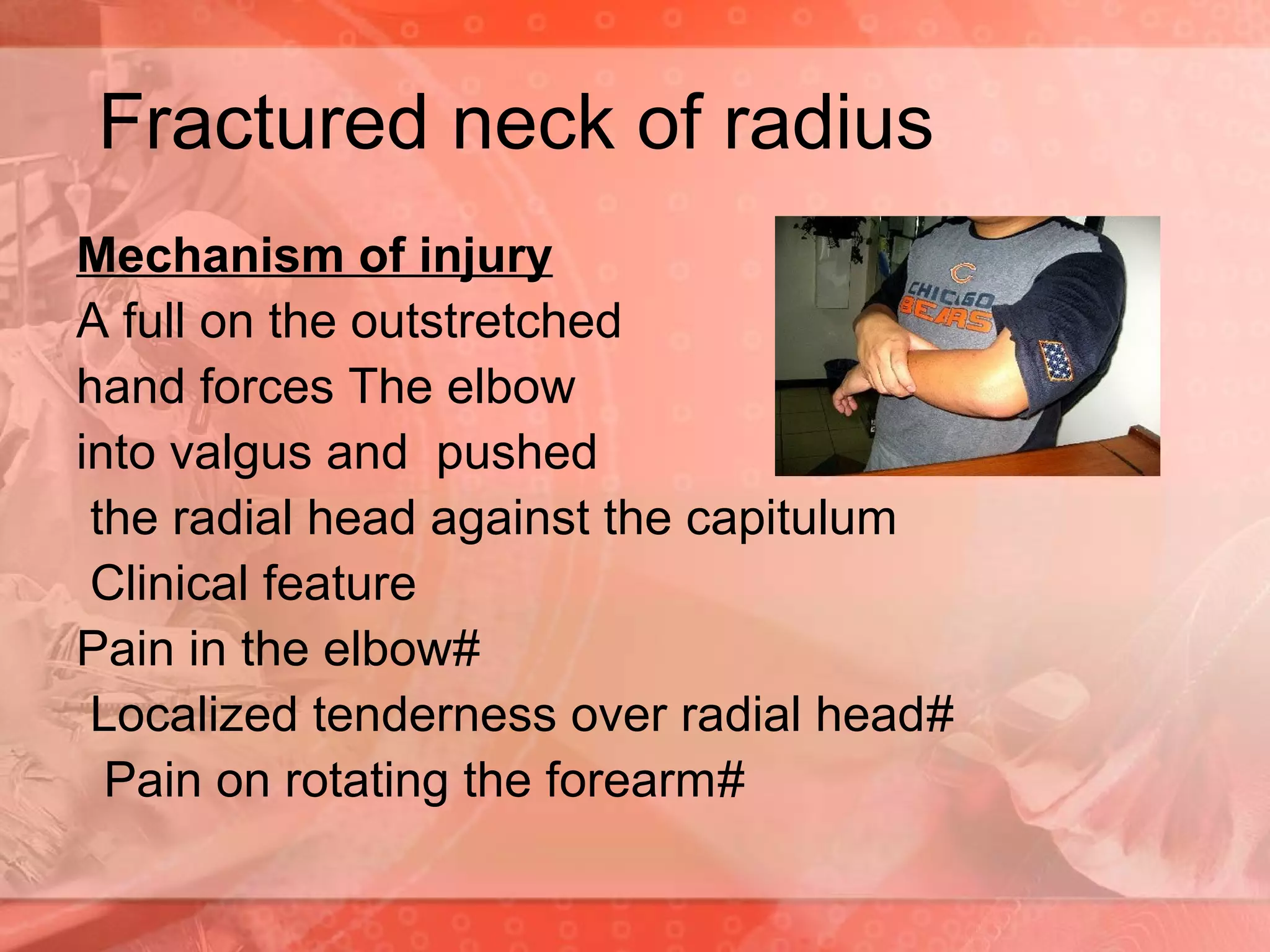 The Elbow Fracture Ppt